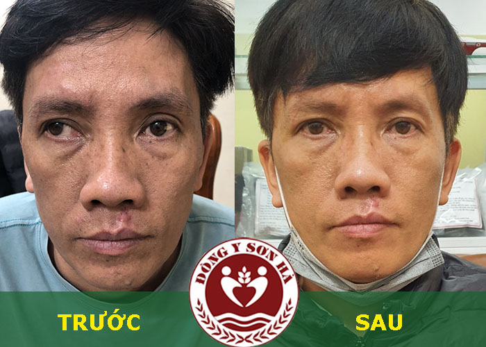 Tại sao mắt bị lác ngoài? Cách điều trị?